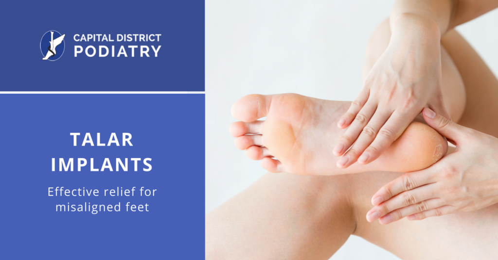 Talar Implants for Misaligned Feet - Capital District Podiatry